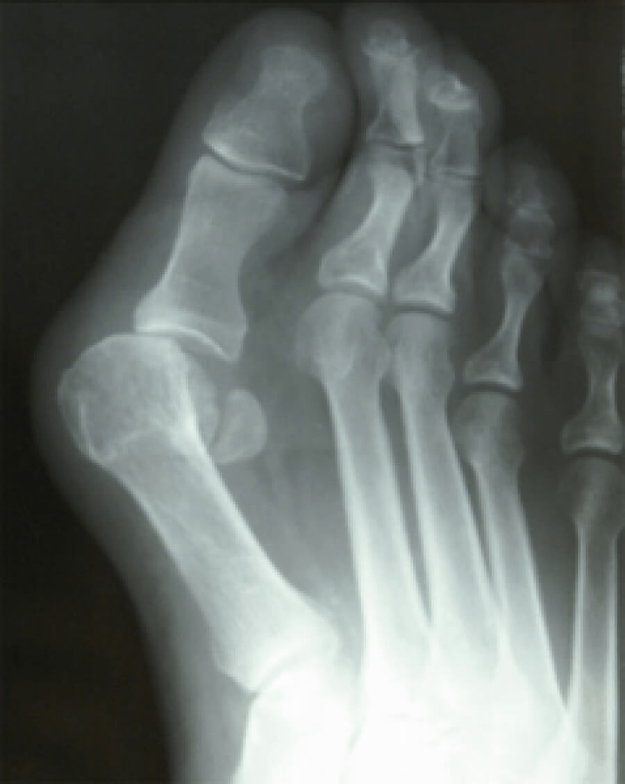 Dr. Brandon Nelson, Board-Certified Foot and Ankle Surgeon discusses ...